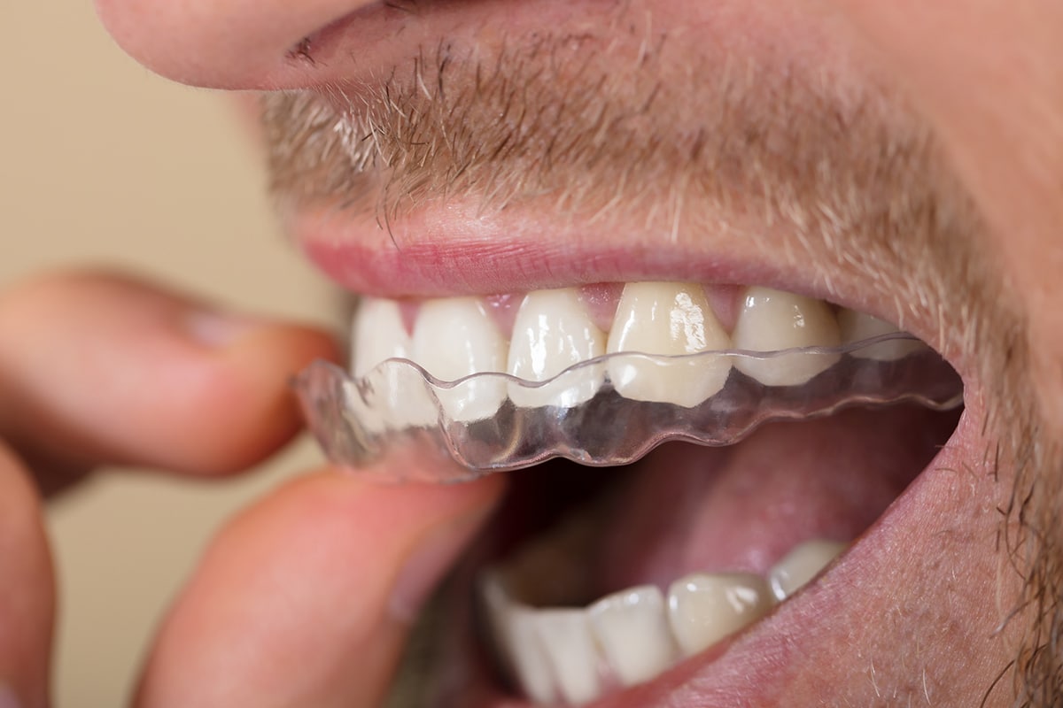 How Long Does Invisalign Take For A Teen? | Maplewood, NJ